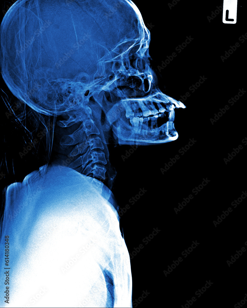 X-ray of neck and cervical spine side view. Image of radiography from ...