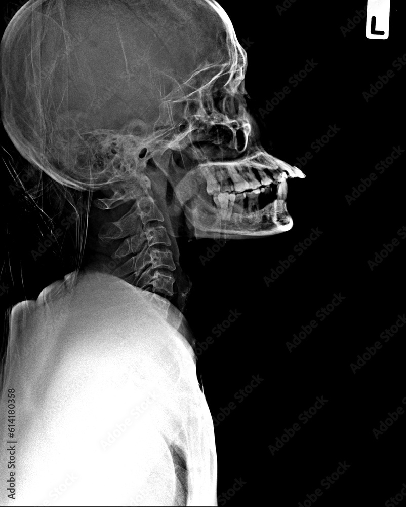 X-ray of neck and cervical spine side view. Image of radiography from ...