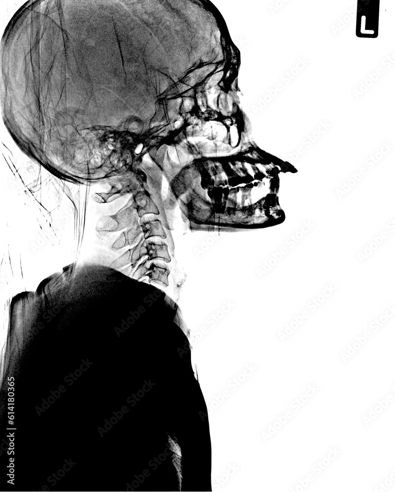X-ray of neck and cervical spine side view. Image of radiography from ...