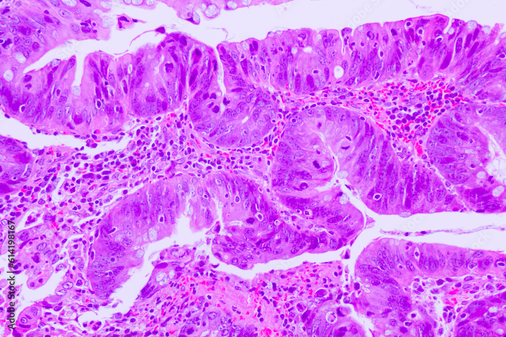 Backgrounds of human cells tissue of lung human under the microscope in ...