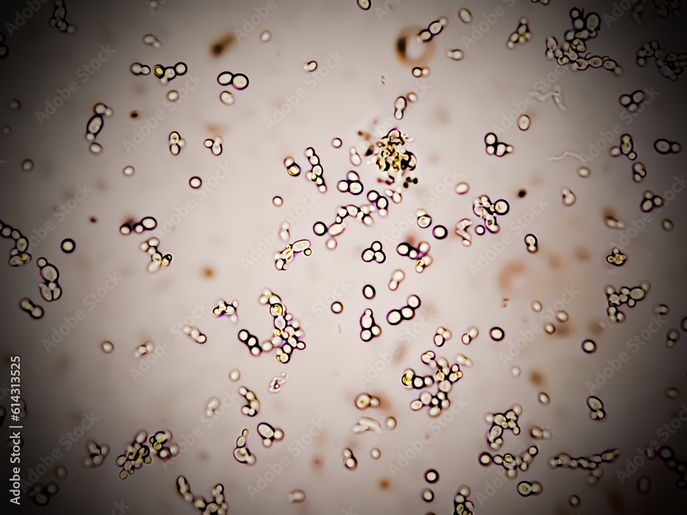 Budding yeast cells in patient urine (urinary tract infections ...