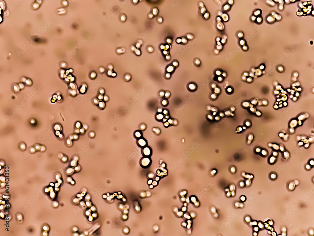 Budding yeast cells in patient urine (urinary tract infections ...