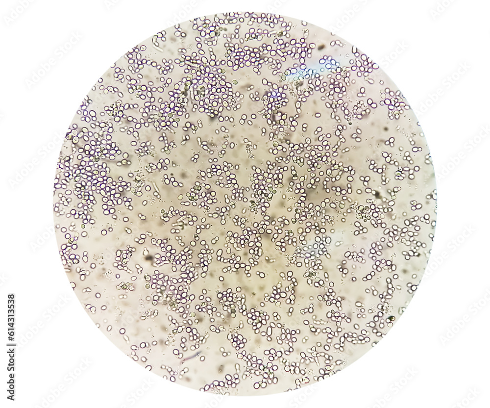 Budding yeast cells in patient urine (urinary tract infections ...