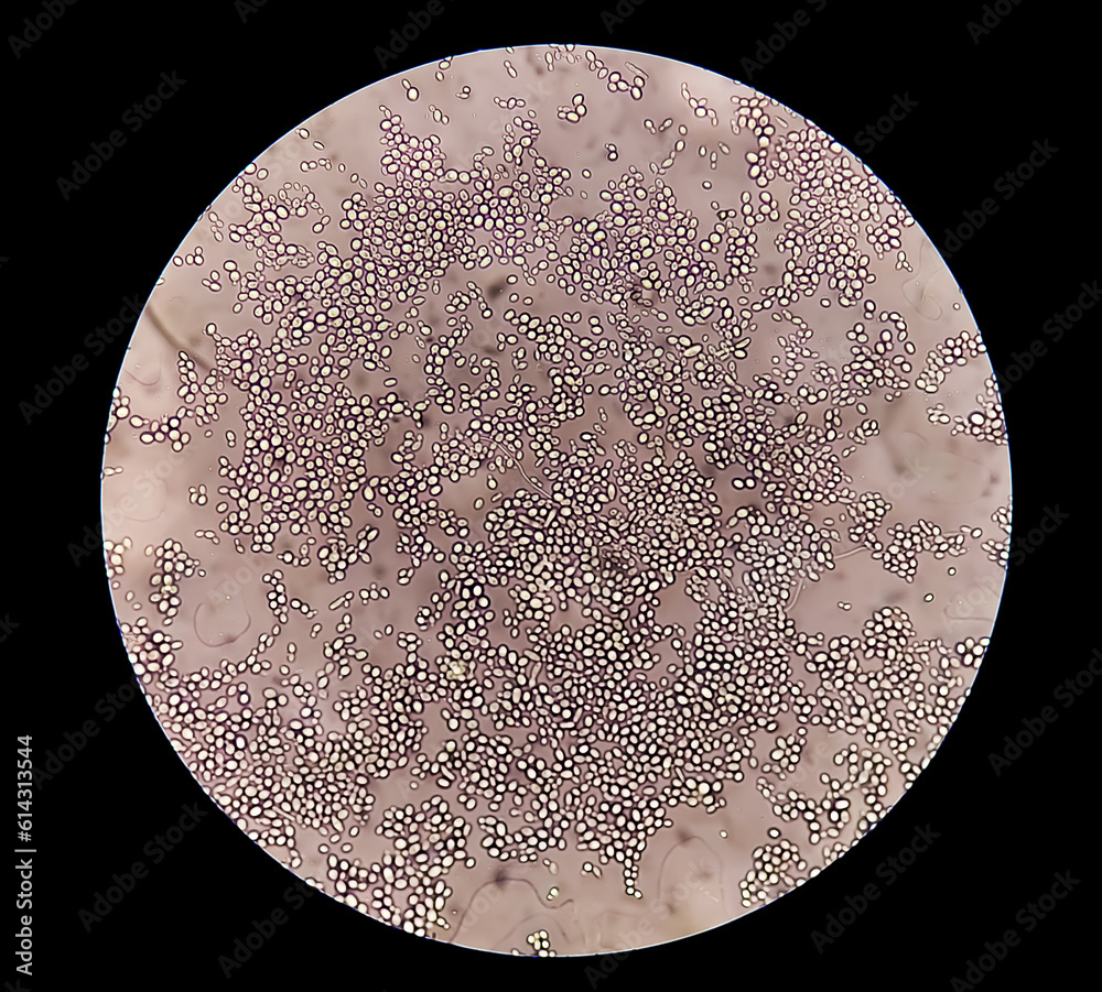 Budding yeast cells in patient urine (urinary tract infections ...