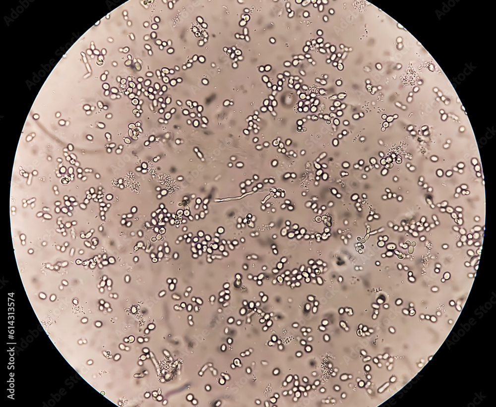 Budding yeast cells in patient urine (urinary tract infections), pyelonephritis or cystitis ...
