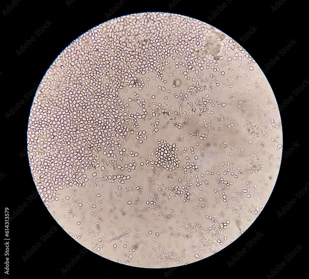 Budding yeast cells in patient urine (urinary tract infections ...