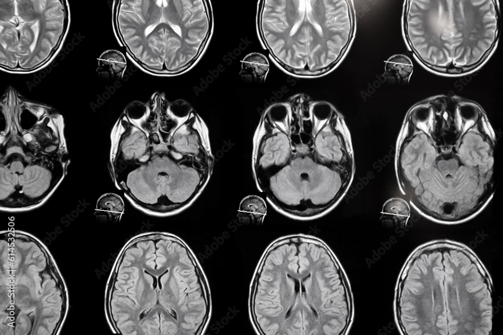 Foto de Macrophoto of computer tomography with the brain. Medical ...