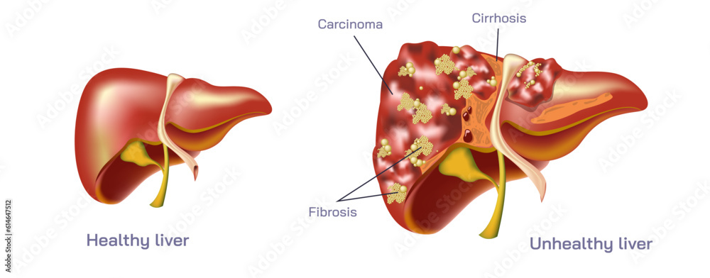 Realistic healthy human liver and unhealthy liver. fatty liver disease ...