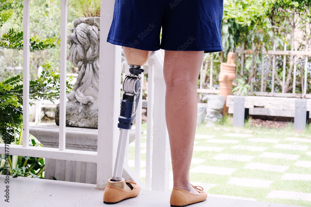 Disabled woman with prosthetic legs prosthetic leg concept. Stock Photo ...