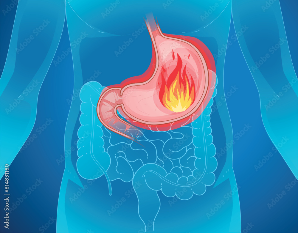 Unhealthy stomach. Gastric ulcers, gastritis. Gastroesophageal reflux ...
