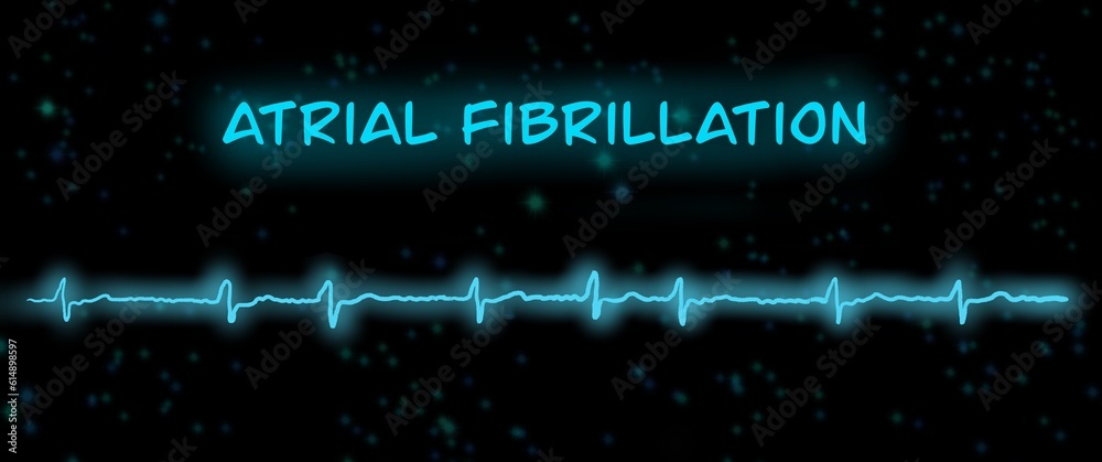 ECG example of atrial fibrillation with light effect Stock Illustration ...