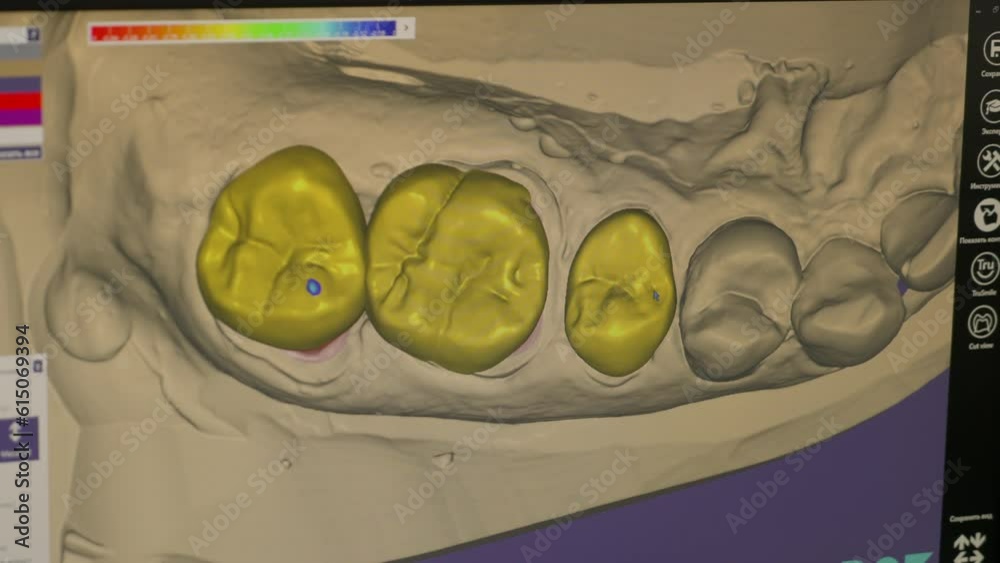 Using the modern dentistry computer program to model the artificial ...