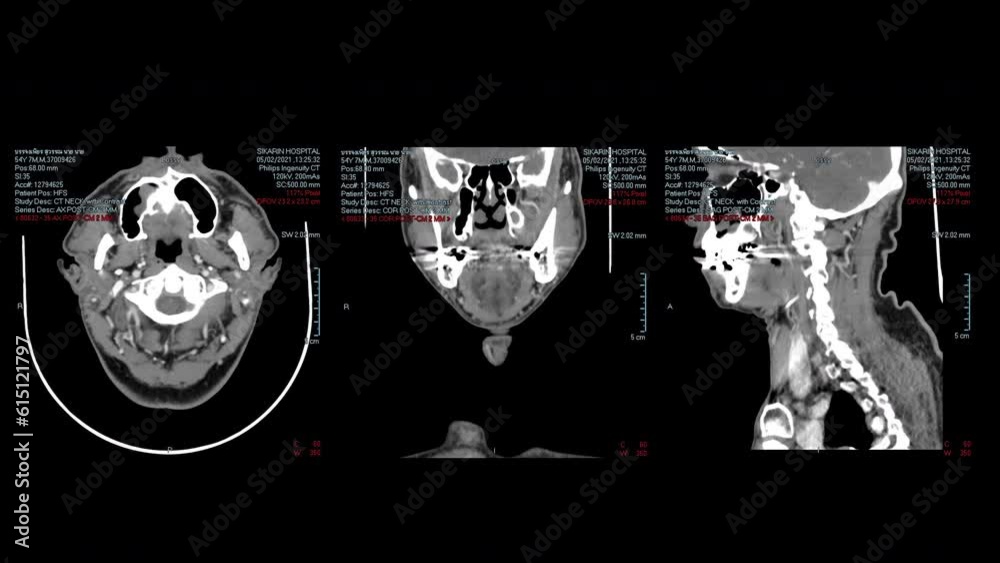 X-rays of the neck, top, front, back, side of a man from a computer ...