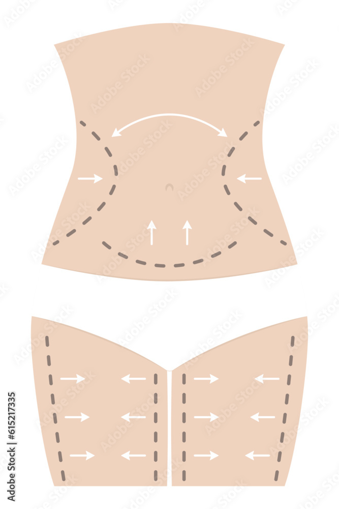 Slim fit woman body with surgical dotted lines before plastic surgery ...
