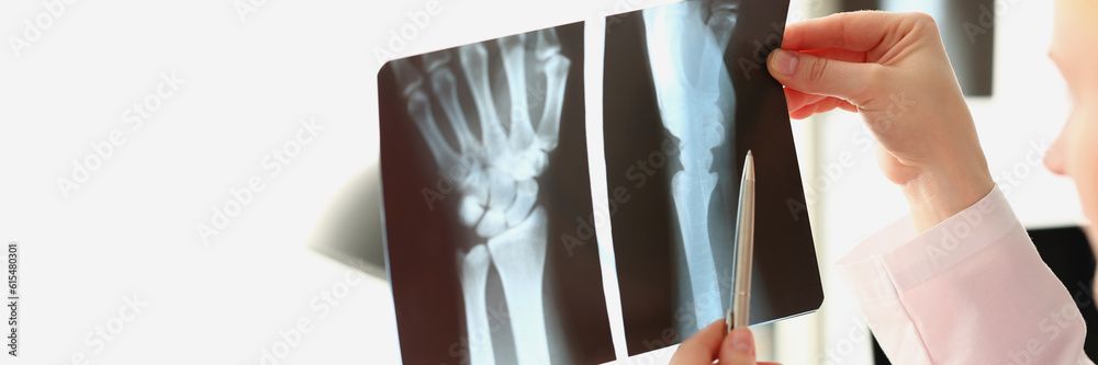 female doctor looks at x-ray of a arm injury in hospital. Sequelae of ...