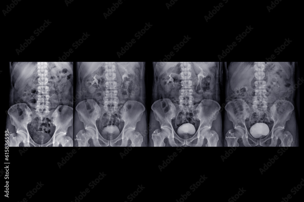 Intravenous pyelogram or I.V.P is an X-ray exam of urinary tract after ...