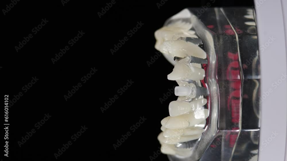 Rotating jaw model of human teeth with implants and placeholder pins ...