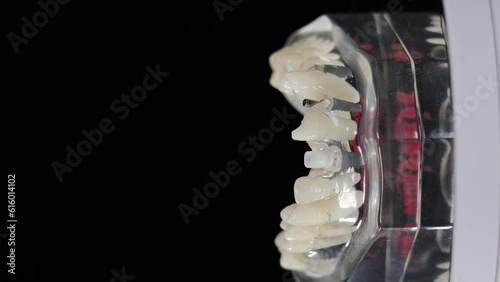 Rotating jaw model of human teeth with implants and placeholder pins ...
