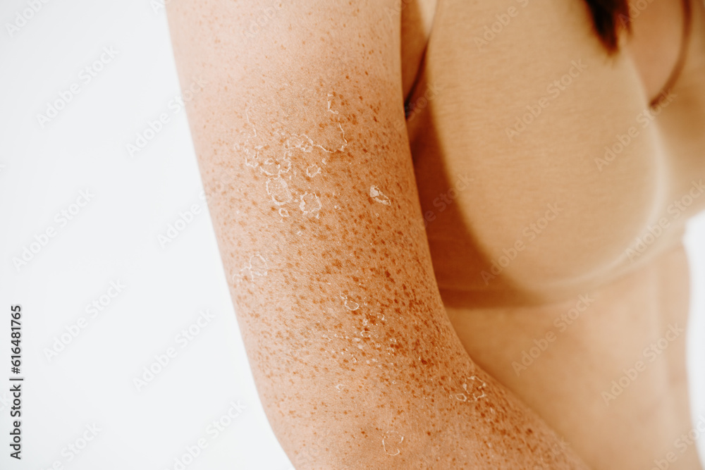 Peeling Skin After Sunburn Dermatology Problems At Woman Hand And