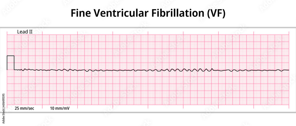 ECG Fine Ventricular Fibrillation - 8 Second ECG Paper - Electrocardiography Medical Vector ...