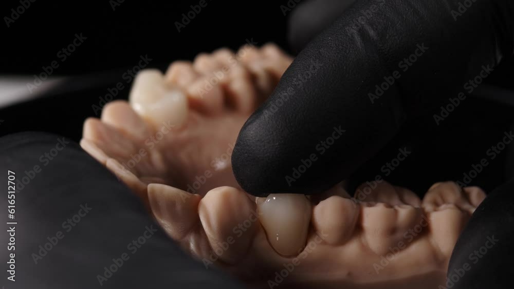 Dental ceramic crowns on teeth model. black background. dental clinic ...