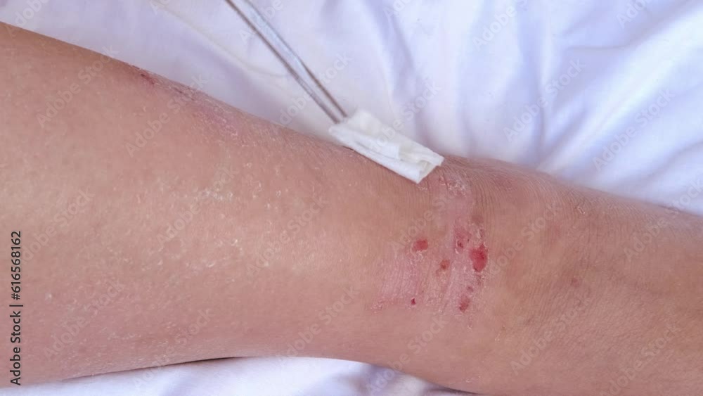 doctor, nurse heals with medicine, ointment, cream wound on female leg ...