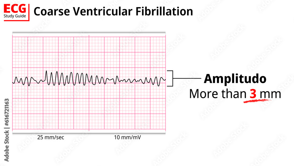 Coarse Ventricular Fibrillation Ecg