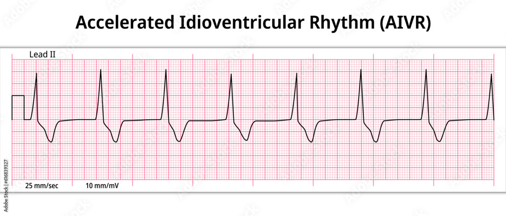 ECG Accelerated Idioventricular Rhythm - 8 Second ECG Paper ...