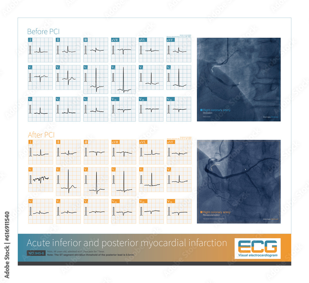 Male, 68 years old, chest pain for 7 hours. Coronary angiography ...