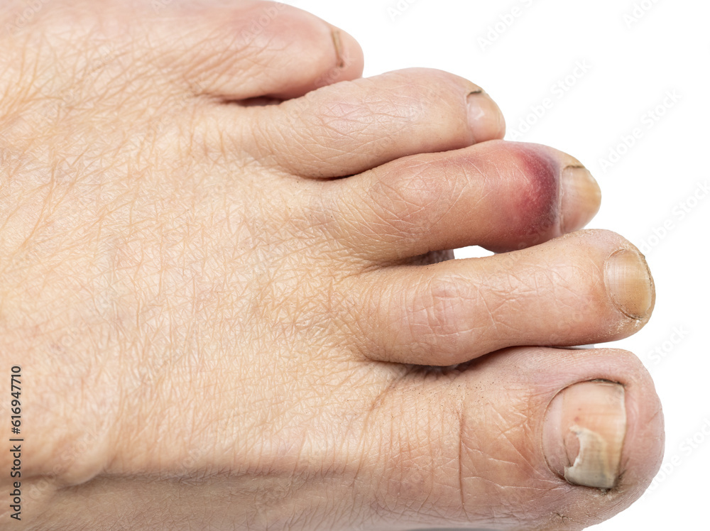 hematoma under toenail as background. Stock Photo | Adobe Stock