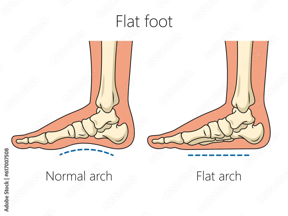 Flat feet bones schematic raster illustration. Medical science ...