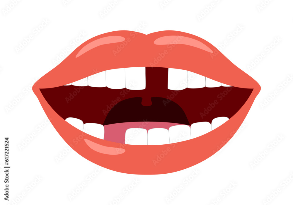 Mouth with missing teeth in flat design on white background. Dental ...