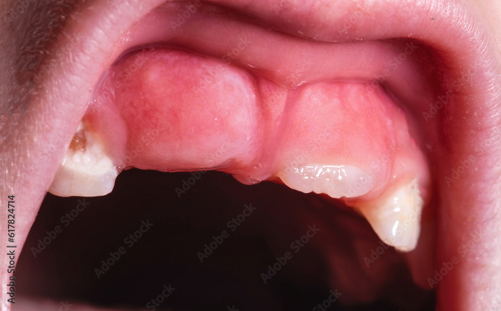 The eruption of a permanent tooth after the loss of a milk tooth in a ...
