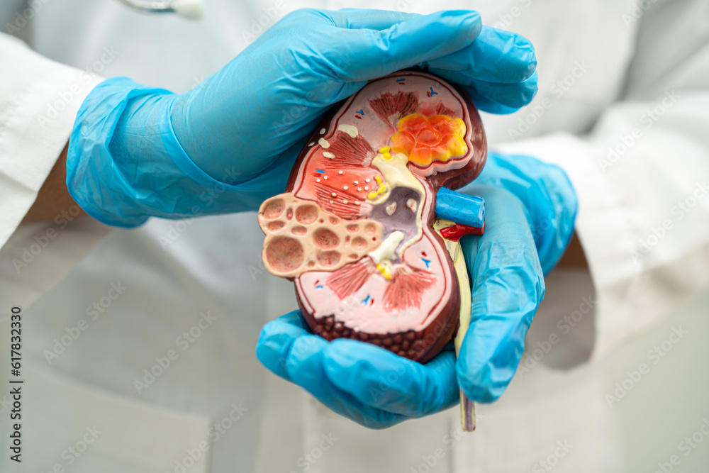 Kidney disease, Chronic kidney disease ckd, Doctor hold model to study ...