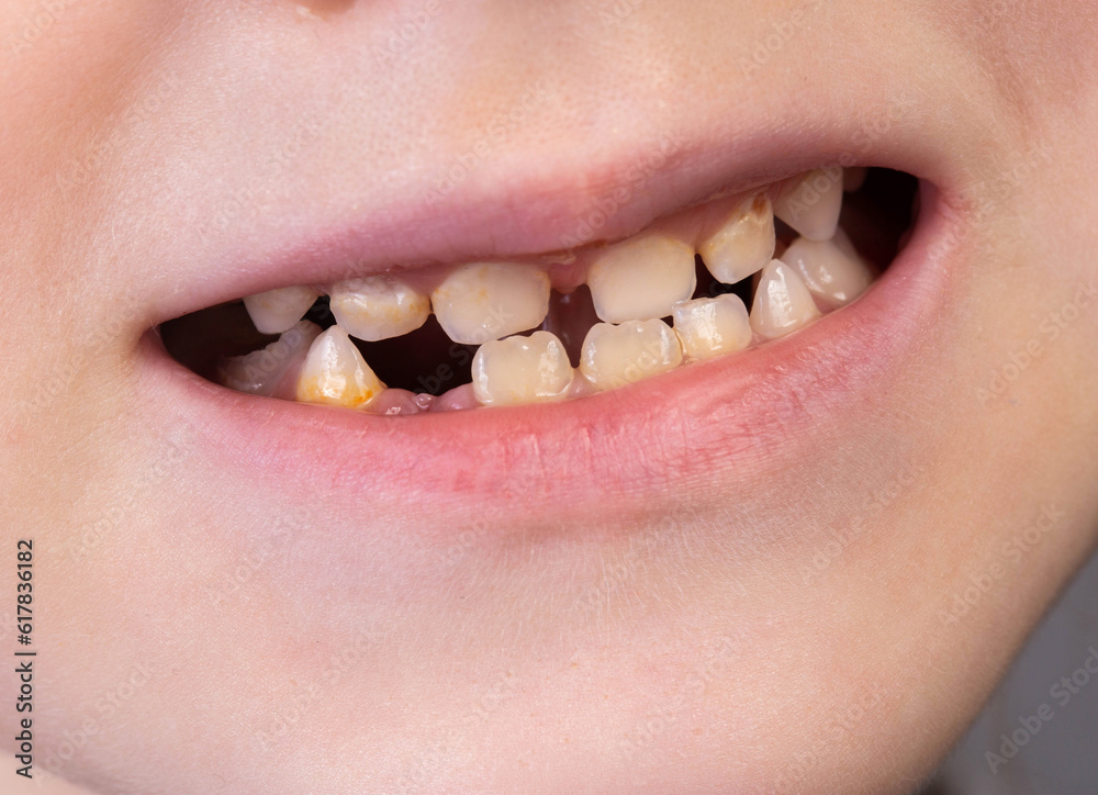 Mouth and smile of a child without one tooth. Loss of milk teeth in ...