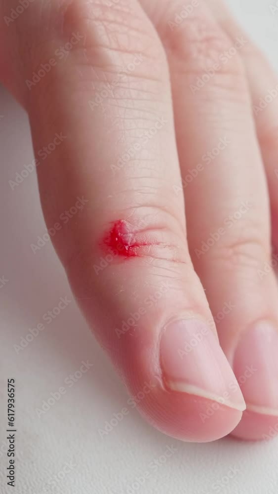 vertically, gel-like red blood clot at the site of a cut on a woman's ...