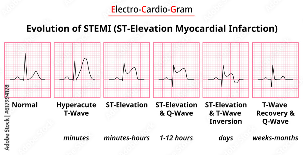 Evolution of STEMI (ST-Elecation Myocardial Infarction ...