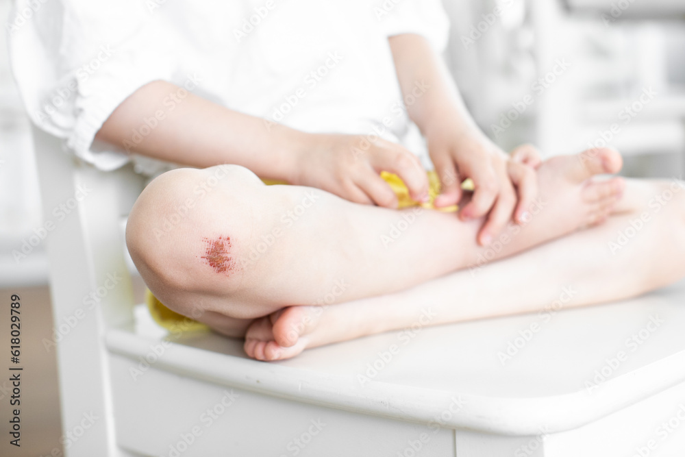 Wound on the girl's knee. The child fell and injured his knee. Scratch ...