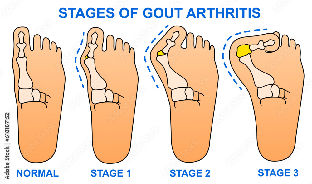 Stages Of Gout Arthritis Bump On The Leg Foot With Gout Hallux Valgus Healthcare