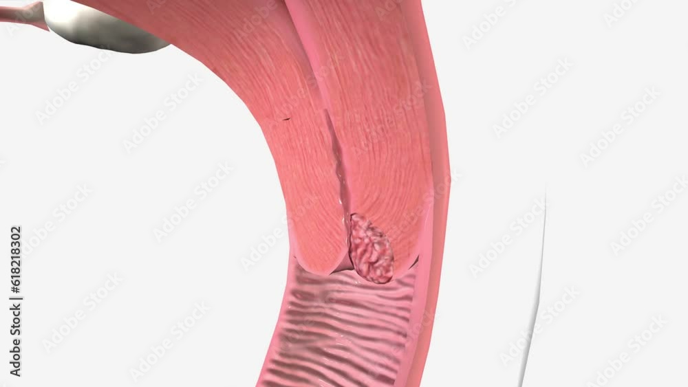 Stage I: The cancer has spread from the cervix lining into the deeper ...