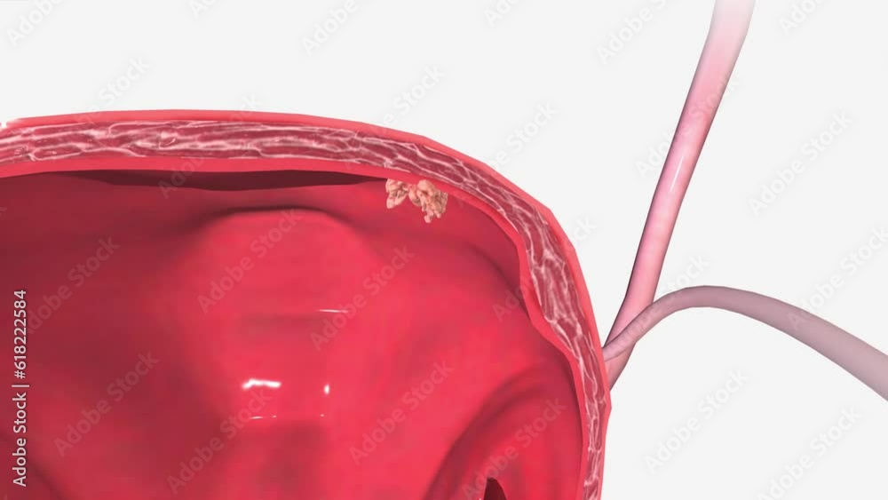 Stage I is a form of non-muscle-invasive bladder cancer that has spread ...