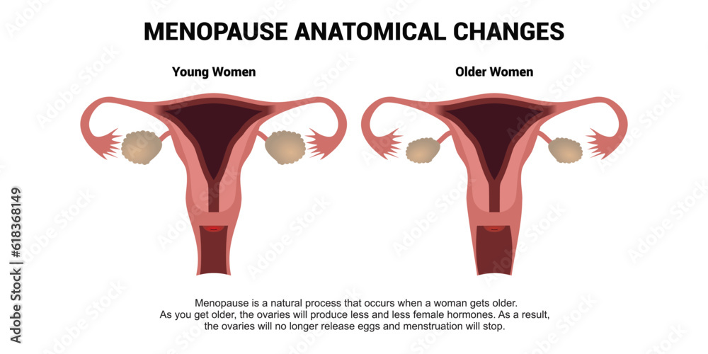 Menopause anatomical changes. Comparison of female reproductive system ...