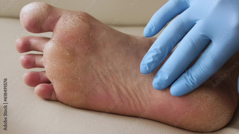 Dry skin of the male foot, Psoriasis of the foot The skin is damaged ...