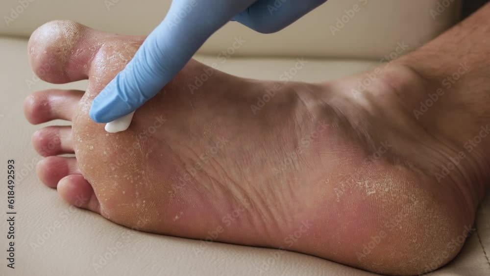 Cream treatment for dry foot skin, foot psoriasis The skin is damaged ...