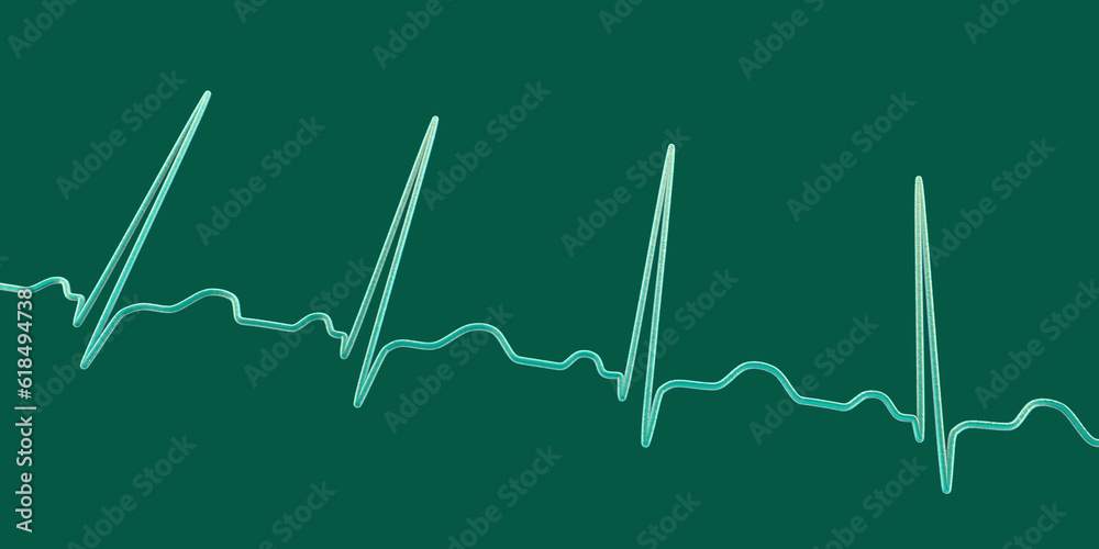 Electrocardiogram ECG displaying sinus tachycardia, 3D illustration ...