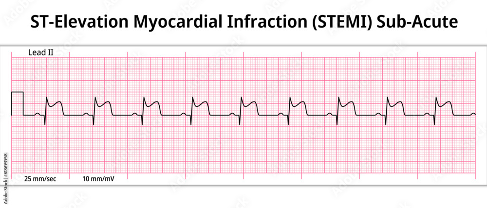 ST-Elevation Myocardial Infarction (STEMI) Sub-Acute - 8 Second ECG ...