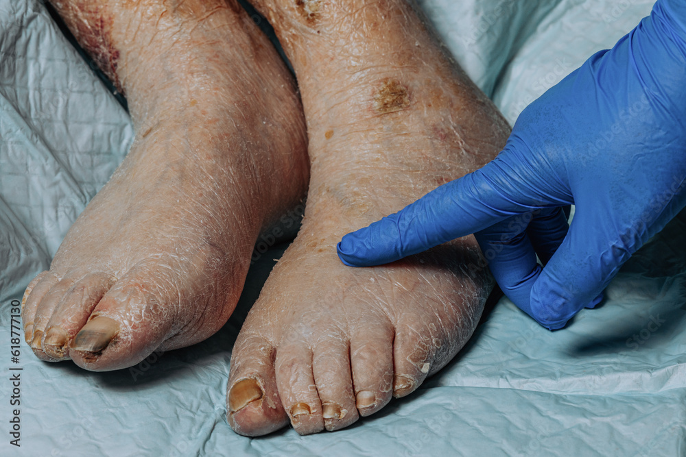 The skin on the legs of an elderly woman peels off due to eczema ...