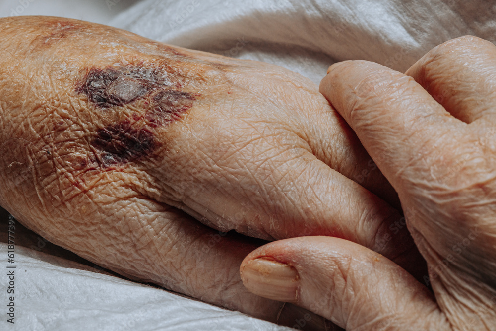 Fotografia do Stock: A bruise on the hand of an elderly person. Known ...