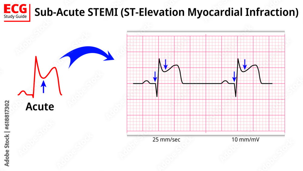 ECG STEMI (ST-Elevation Myocardial Infarction) Sub-Acute - ECG ...