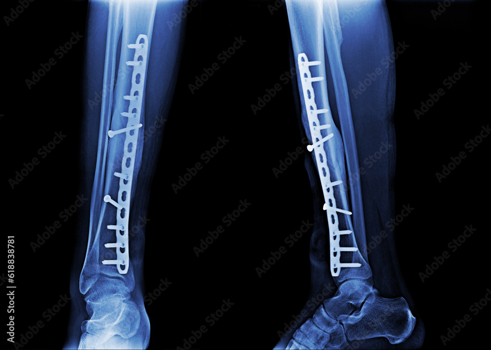 Foto de leg fracture and surgical treatment by internal fixation with ...